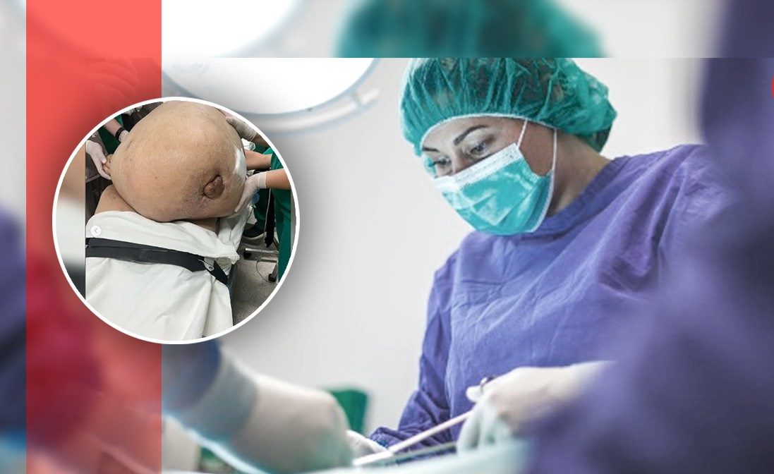 Médicos Brasileños Le Extirpan Enorme Tumor De 46 Kilos A Una Mujer